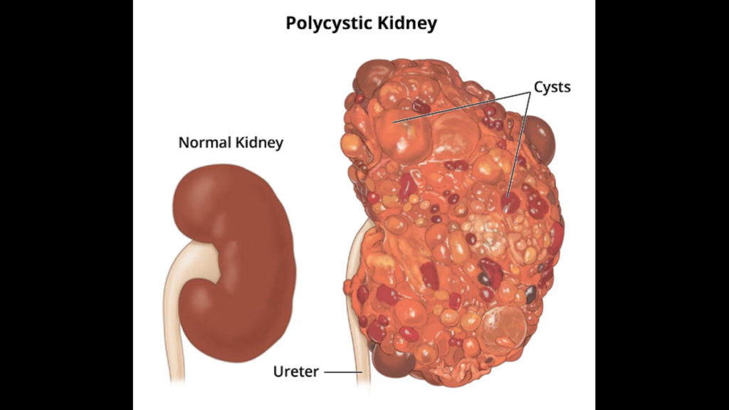 Polycystic kidney disease